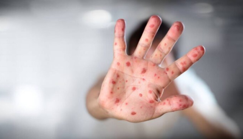 Un brote de sarampión en Río Negro puso en alerta a la provincia de ...